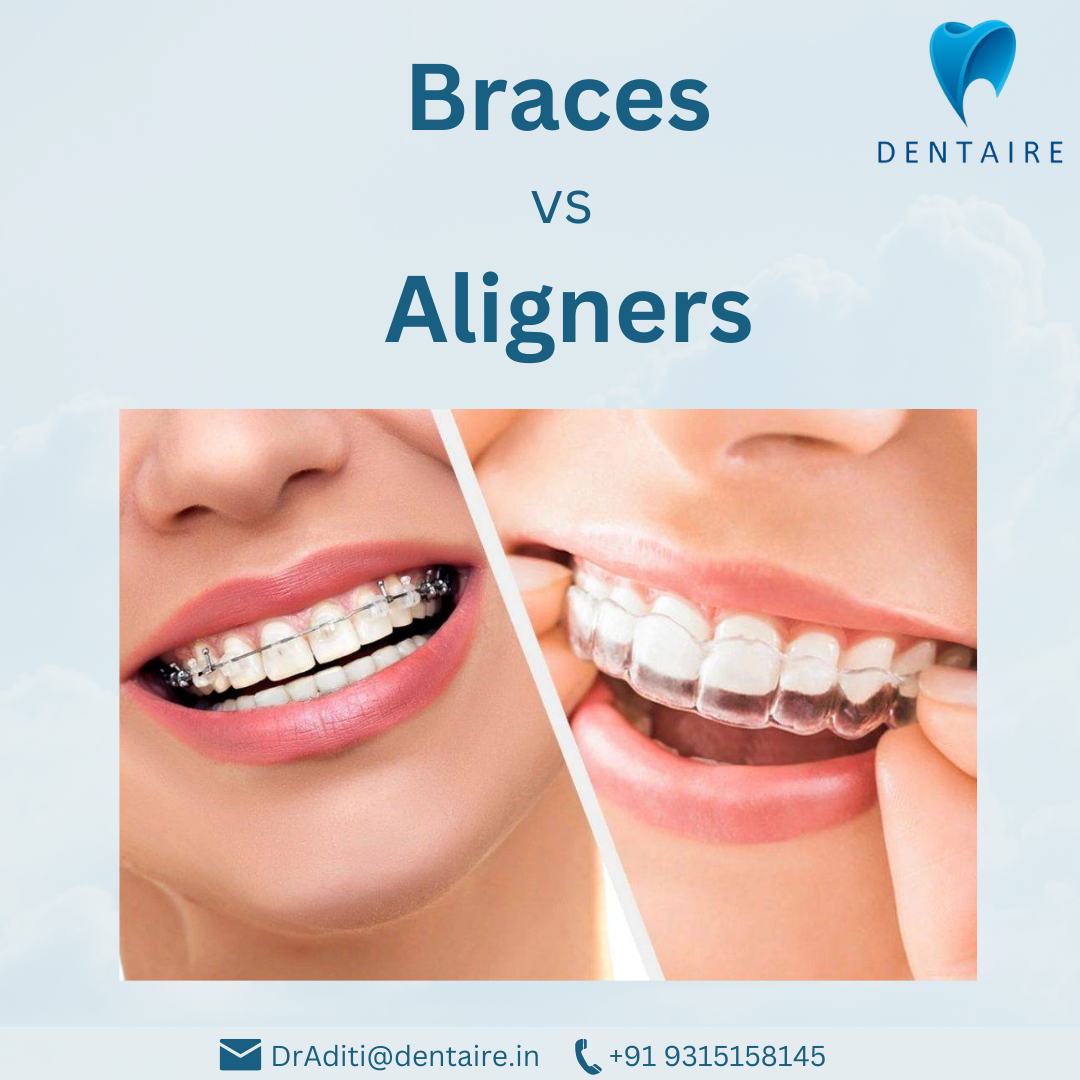 Aligners vs. Braces: Cost Comparison and Benefits